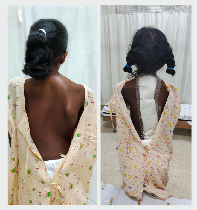 Rela Hospital Performs Rare Spine Surgery, From an “S” Shaped Spine to ...